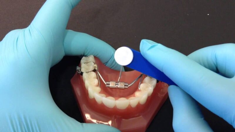 What Are the Benefits of Palatal Expanders? - Planet Bead